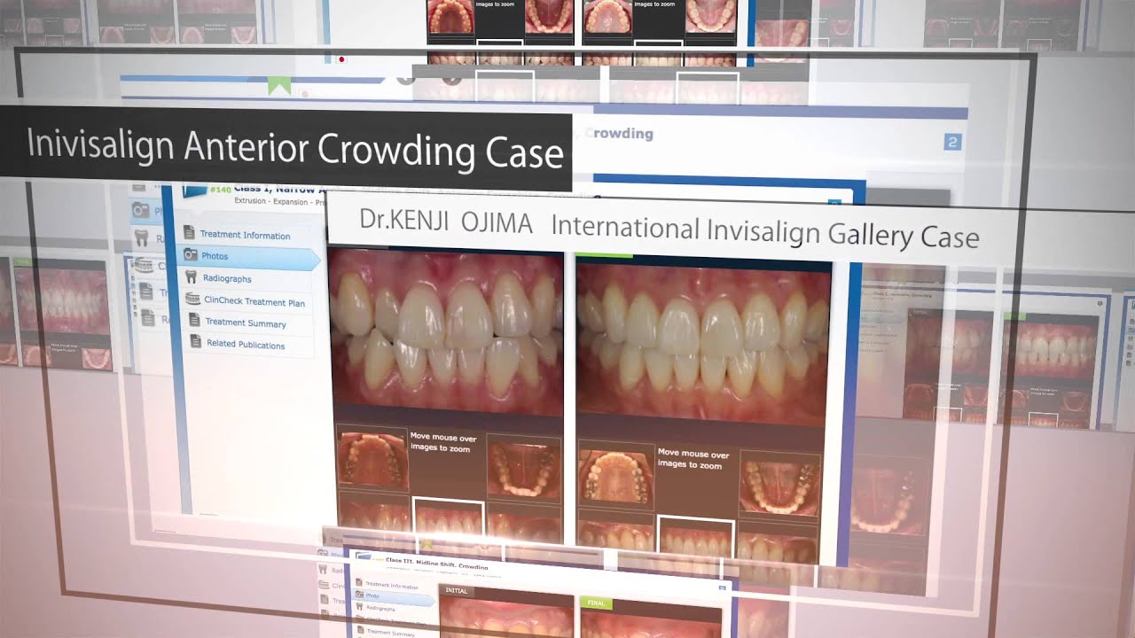 International Invisalign Gallery cases,Dr.Kenji Ojima - YouTube