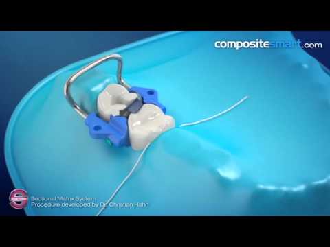 SmartView Sectional Matrix - Rubber Dam Clamp Procedure - YouTube