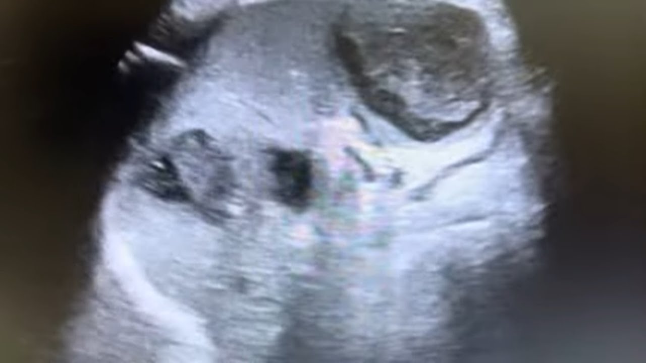 ultrasound of Bull eye sign / wheel within wheel sign . Hepatospleenic ...