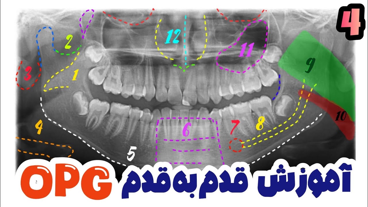آموزش کامل رادیوگرافی OPG | بافت های نرم و ghost images و ساختار های ...