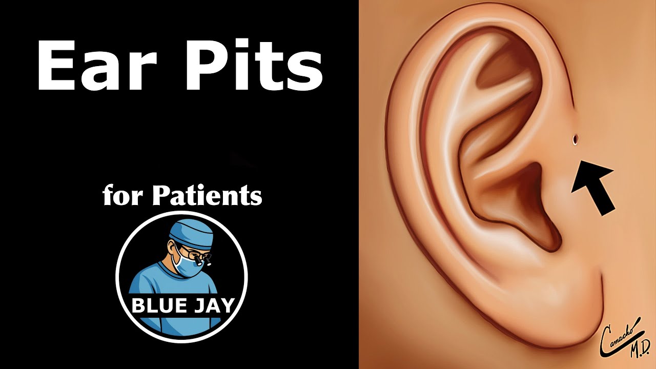 Ear Pits: Patient Education - YouTube