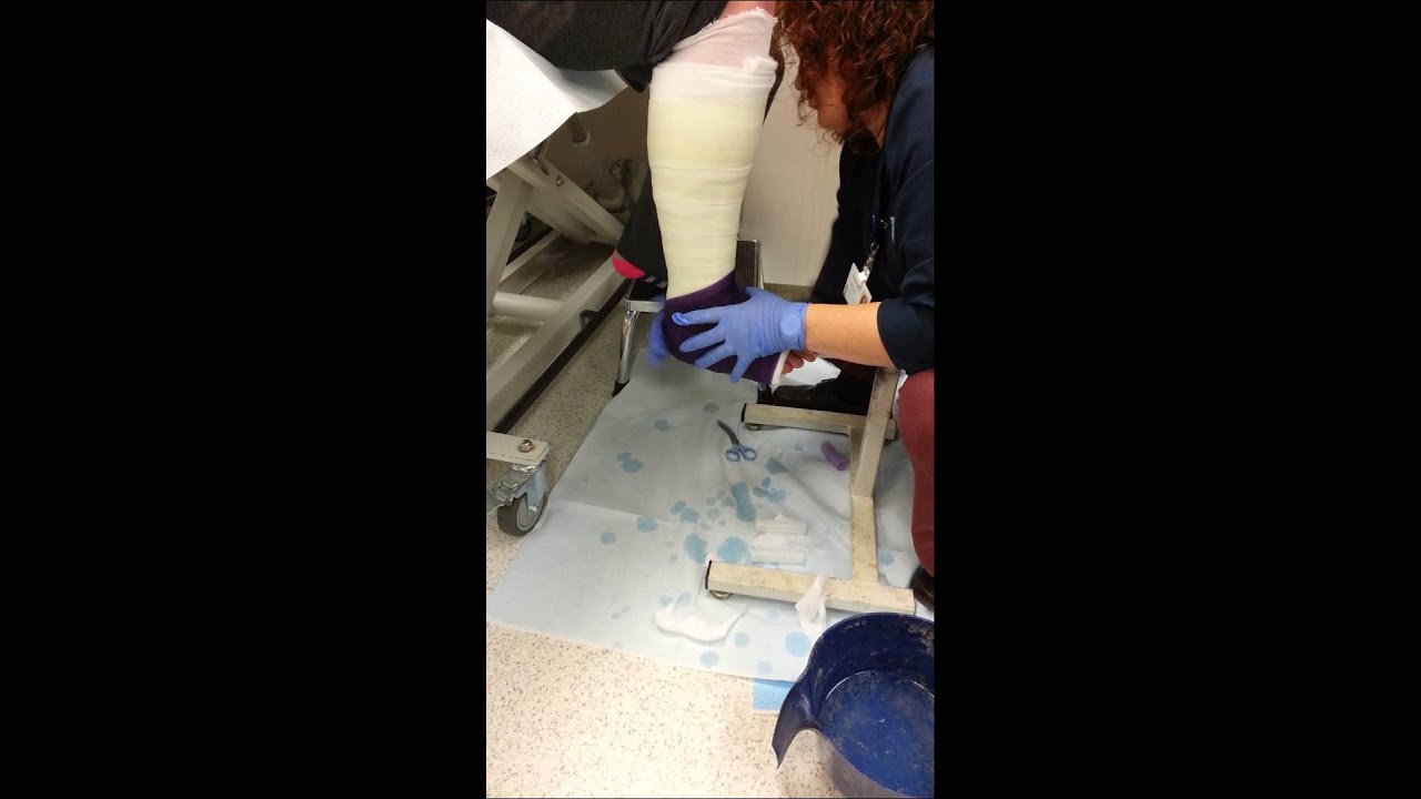 Hard cast being put on - YouTube