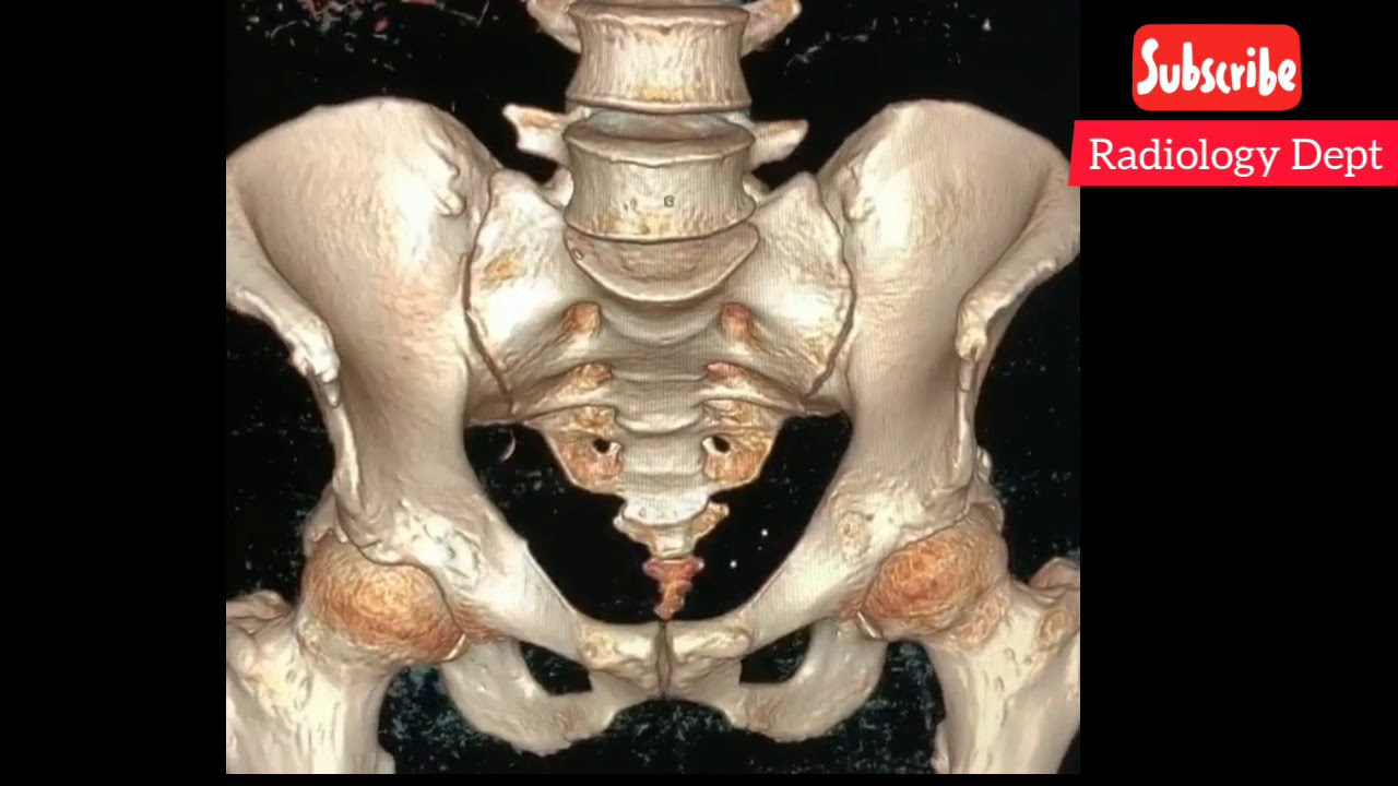 CT Scan Hip Joint || CT Scan Pelvis With Both Hip Joints || VRT || # ...
