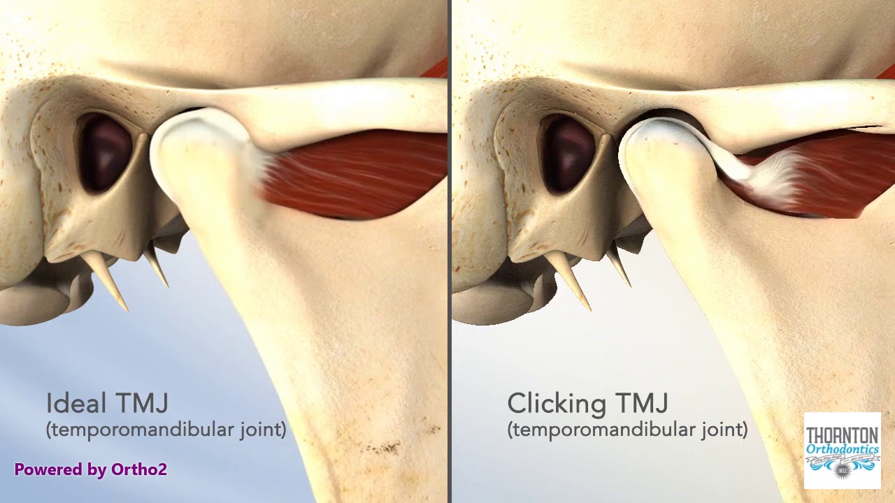TMJ Clicking - YouTube