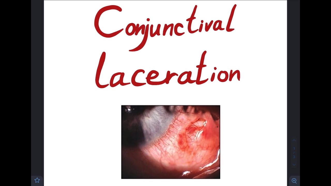 Conjunctival Laceration