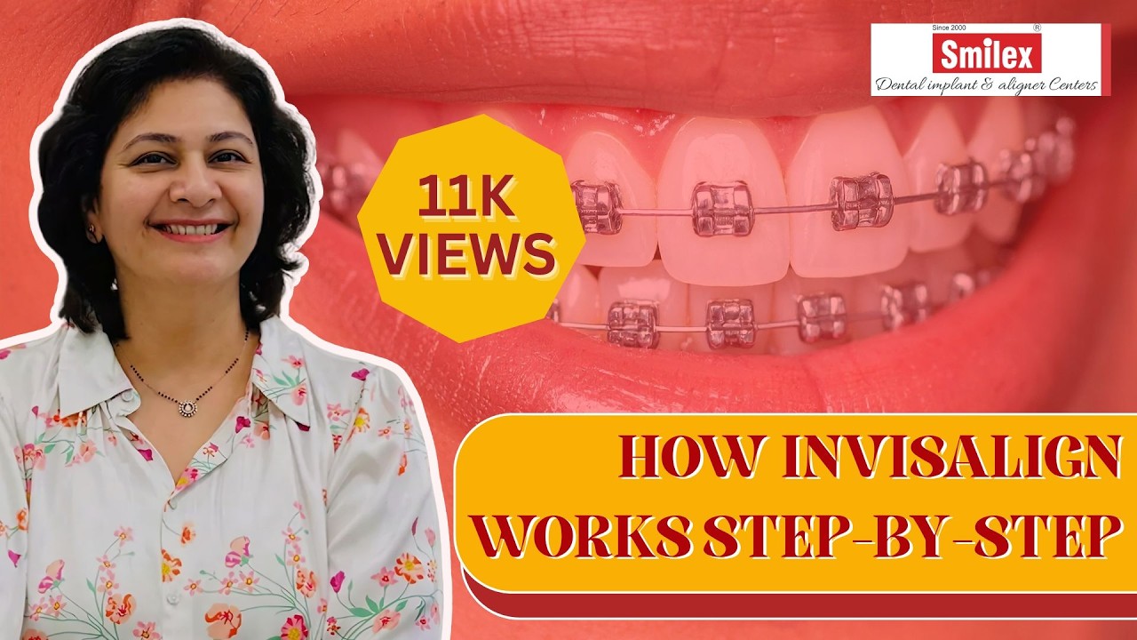 How Invisalign Aligners Work Step-by-Step | Clear Aligners Explained by ...