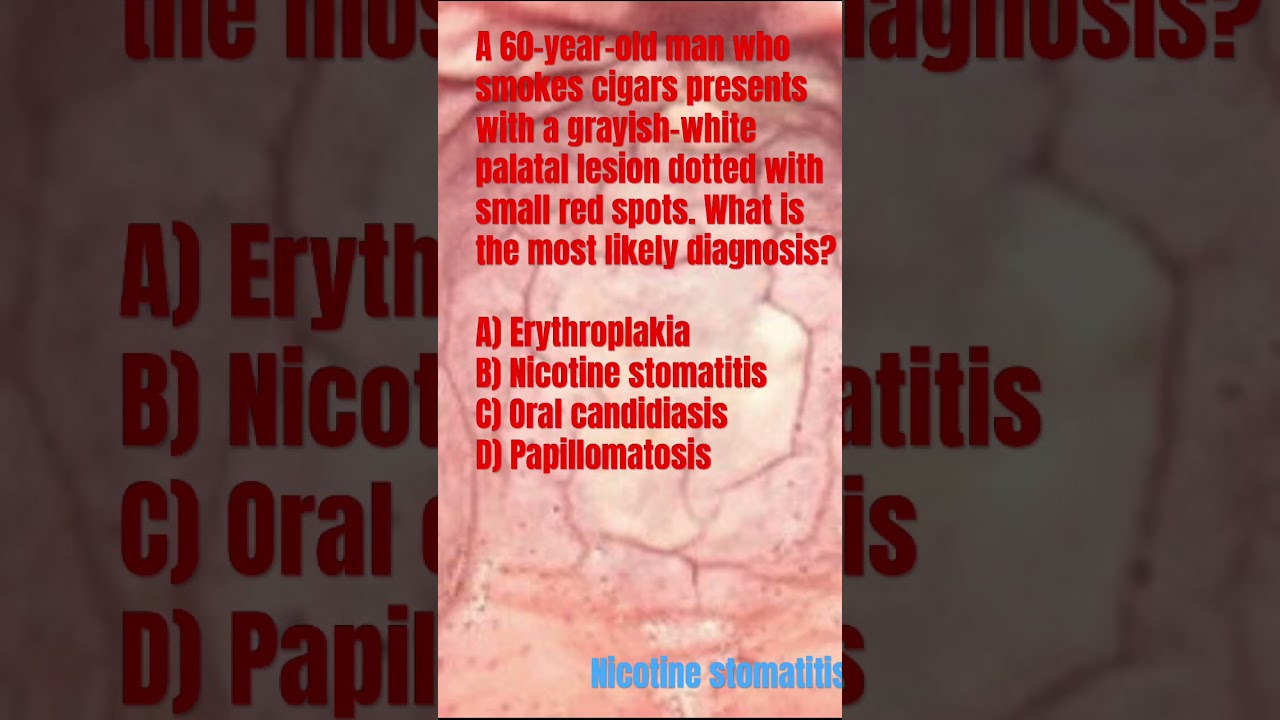 Nicotine Stomatitis Images Vaping Linked To AD, PsO, Burns, And More