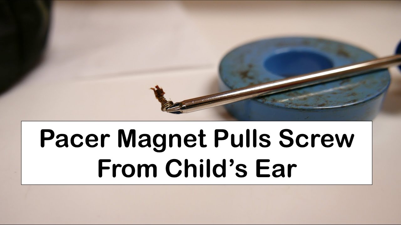 Pacer Magnet Pulls Screw From Child's Ear - YouTube