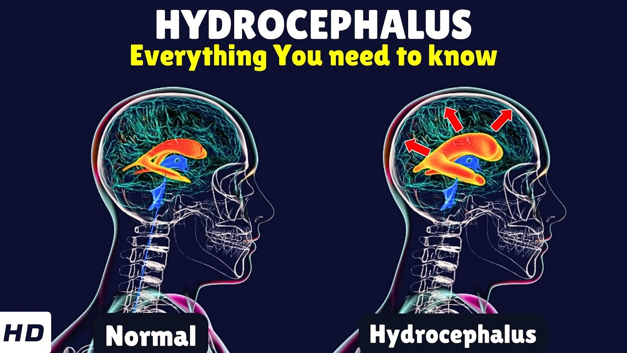 Hydrocephalus – Causes, Signs and Symptoms, Diagnosis & Treatment - YouTube