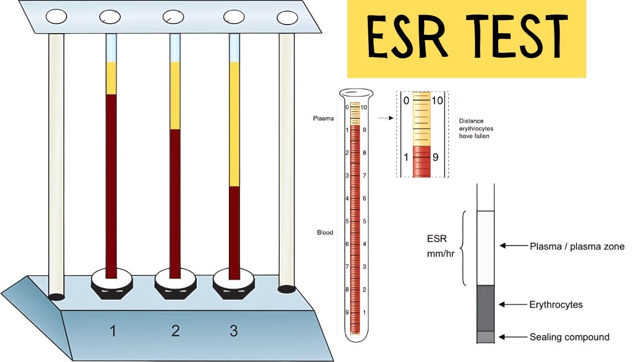 Erythrocyte Sedimentation Rate (ESR) Test What You Need To Know - YouTube