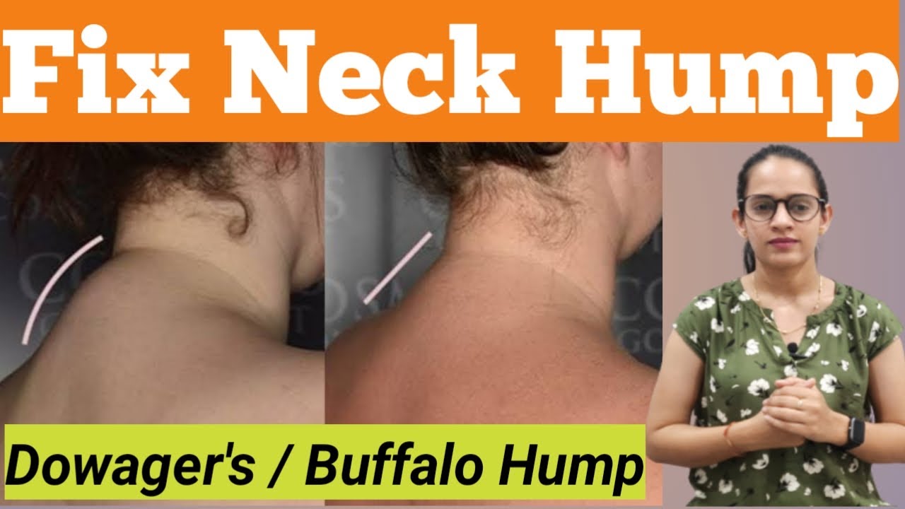 Fix Neck Hump FAST | Correct Posture | Neck Hump Fat Loss Exercises ...