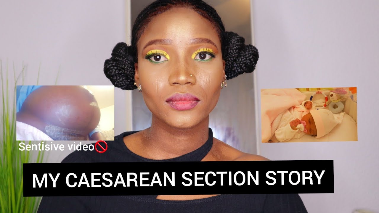 My CS Birth Story | Caesarean Section (unplanned) - YouTube