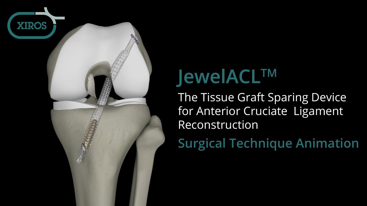 JewelACL™ Partial Tissue Graft Sparing Surgical Technique Animation ...