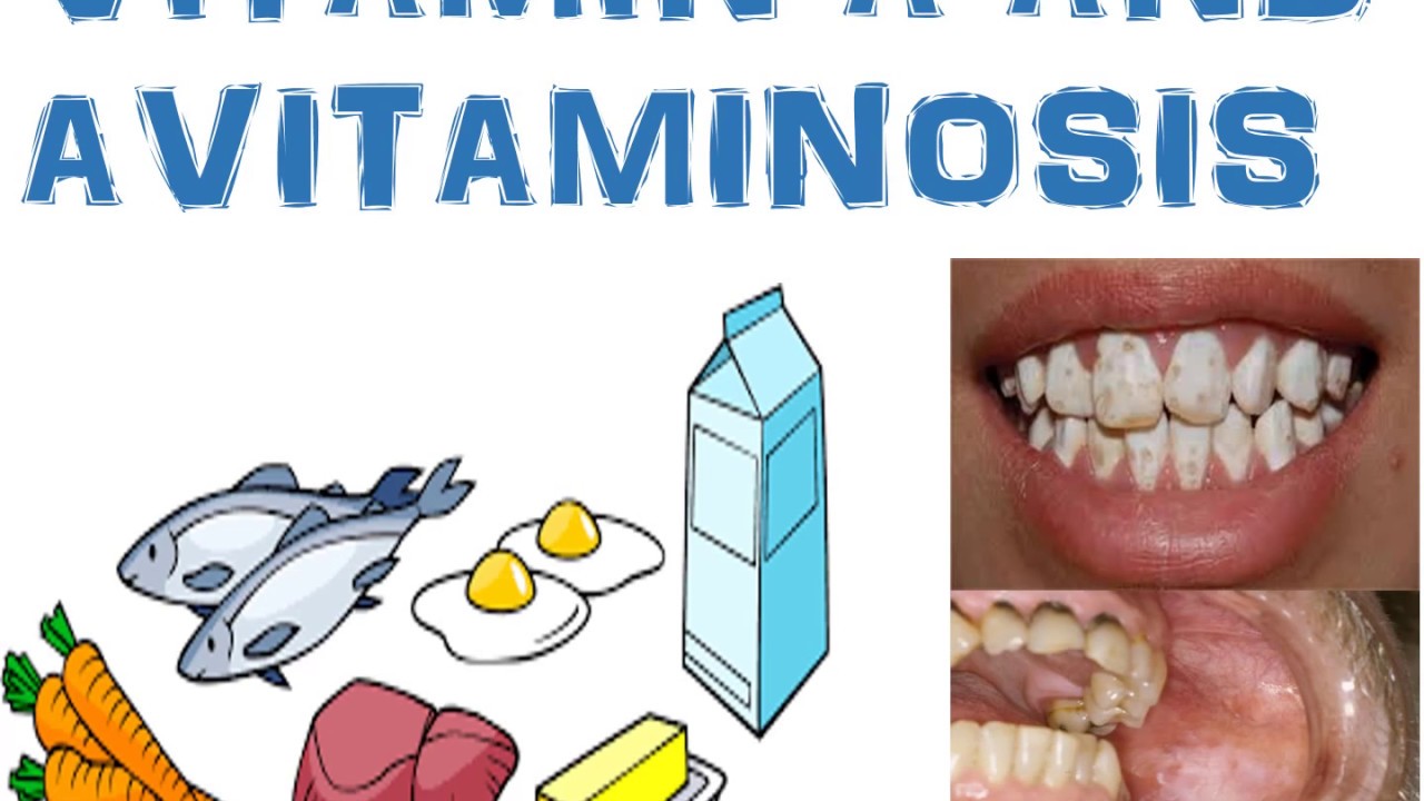 Hypervitaminosis A