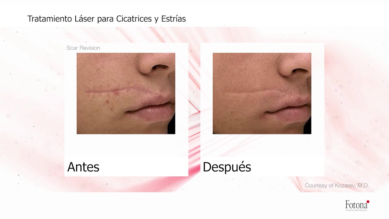 Tratamiento Laser para Cicatrices y Estrías - Láser Fotona - YouTube