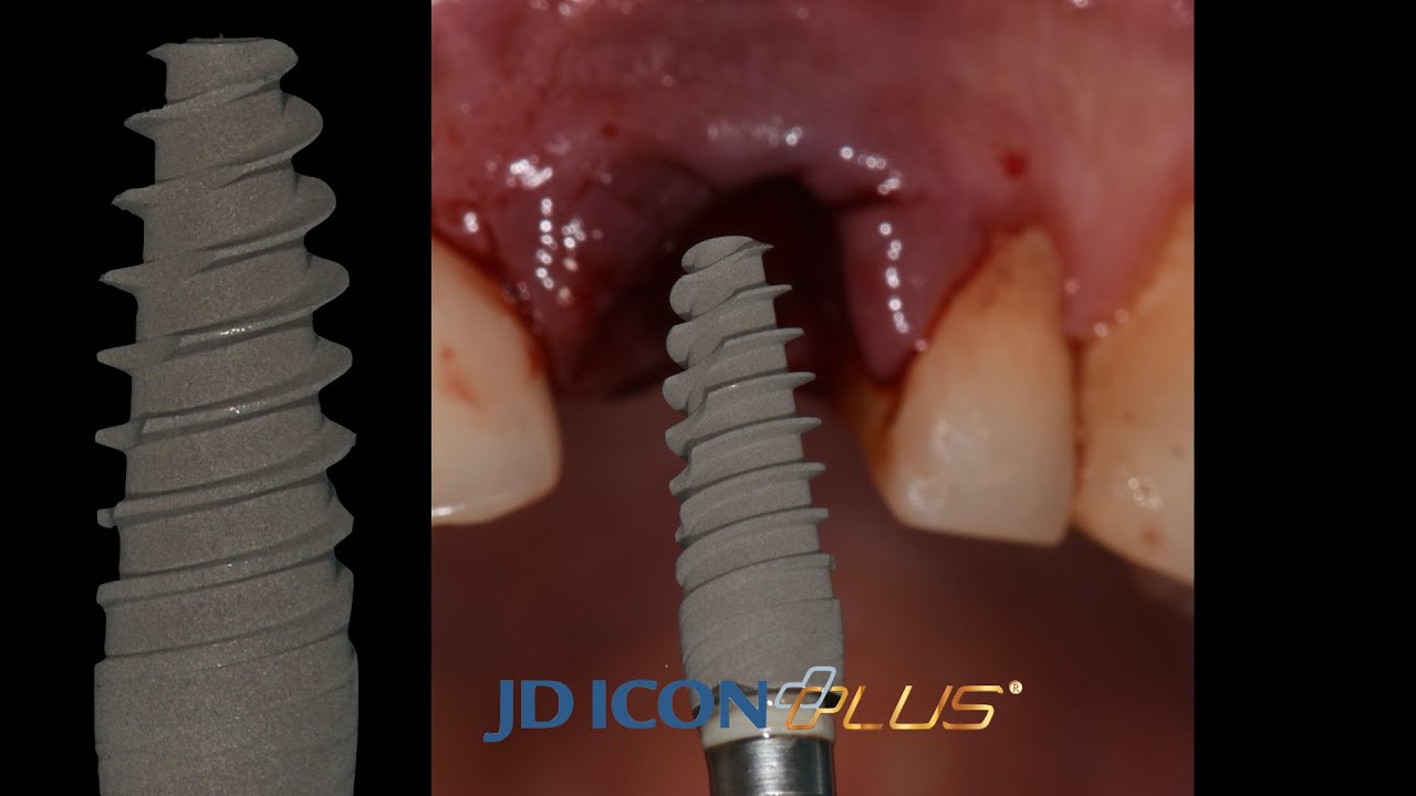 JD ICON PLUS IMMEDIATE PLACEMENT. BY DR BECHARA - YouTube