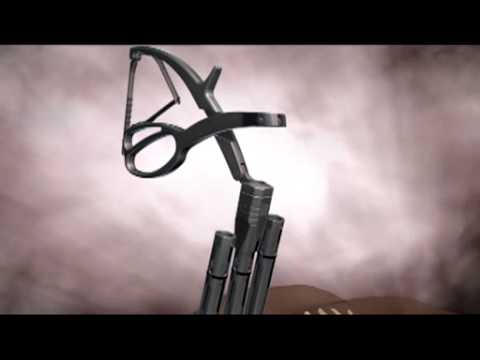 Expedium Viper 2 Rod Approximator Video - YouTube