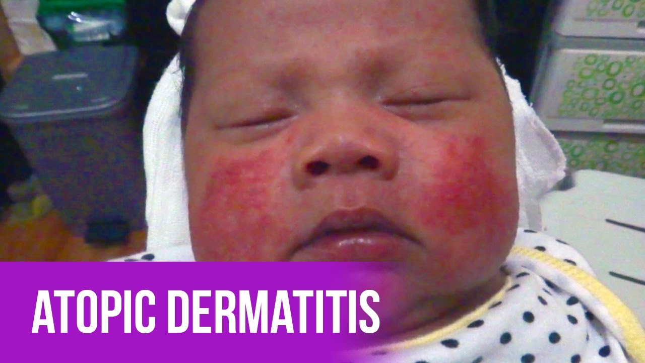 My baby has rashes?! ATOPIC DERMATITIS in Infants (Infantile Eczema ...
