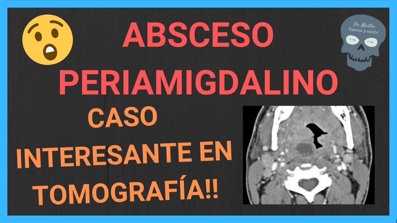 ABSCESO PERIAMIGDALINO [tomografía]💥 - YouTube