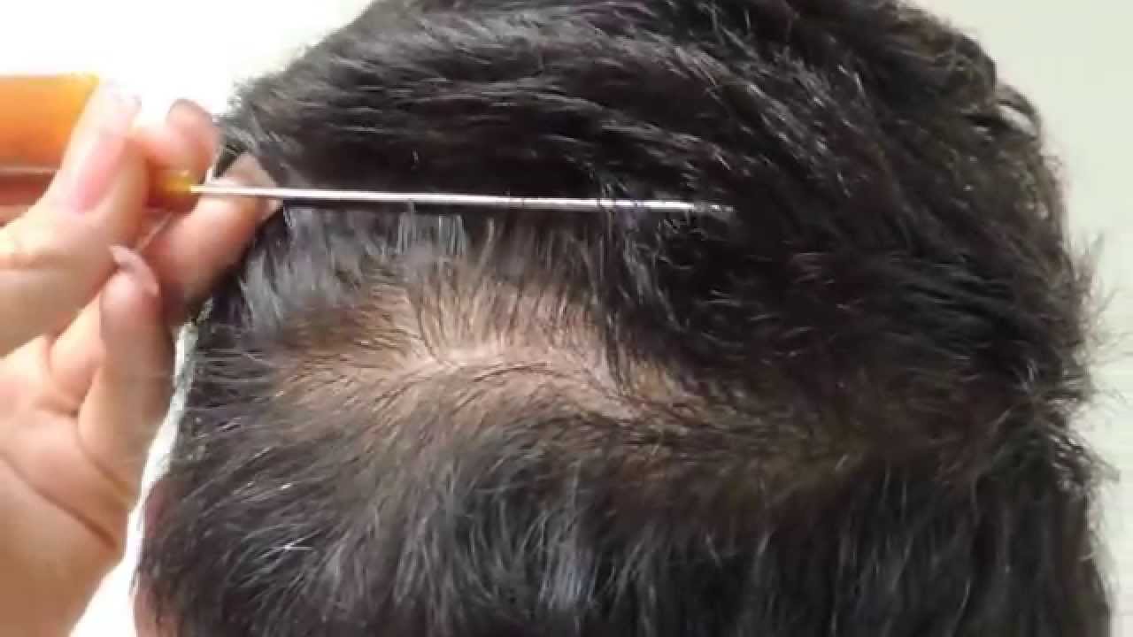 Trichophytic closure by Neopel Hair Clinic - YouTube