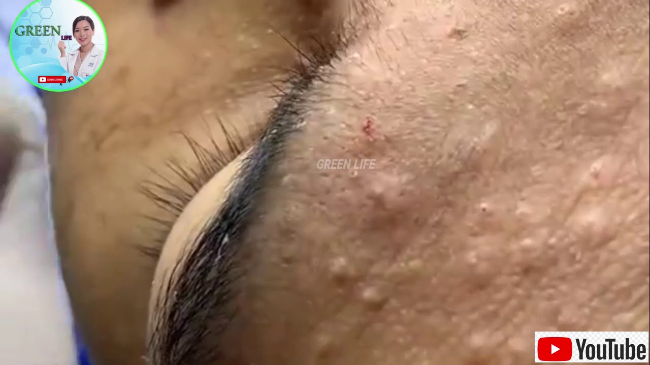 How to get rid of acne and pimples on forehead | Acne Treatment #G15 ...