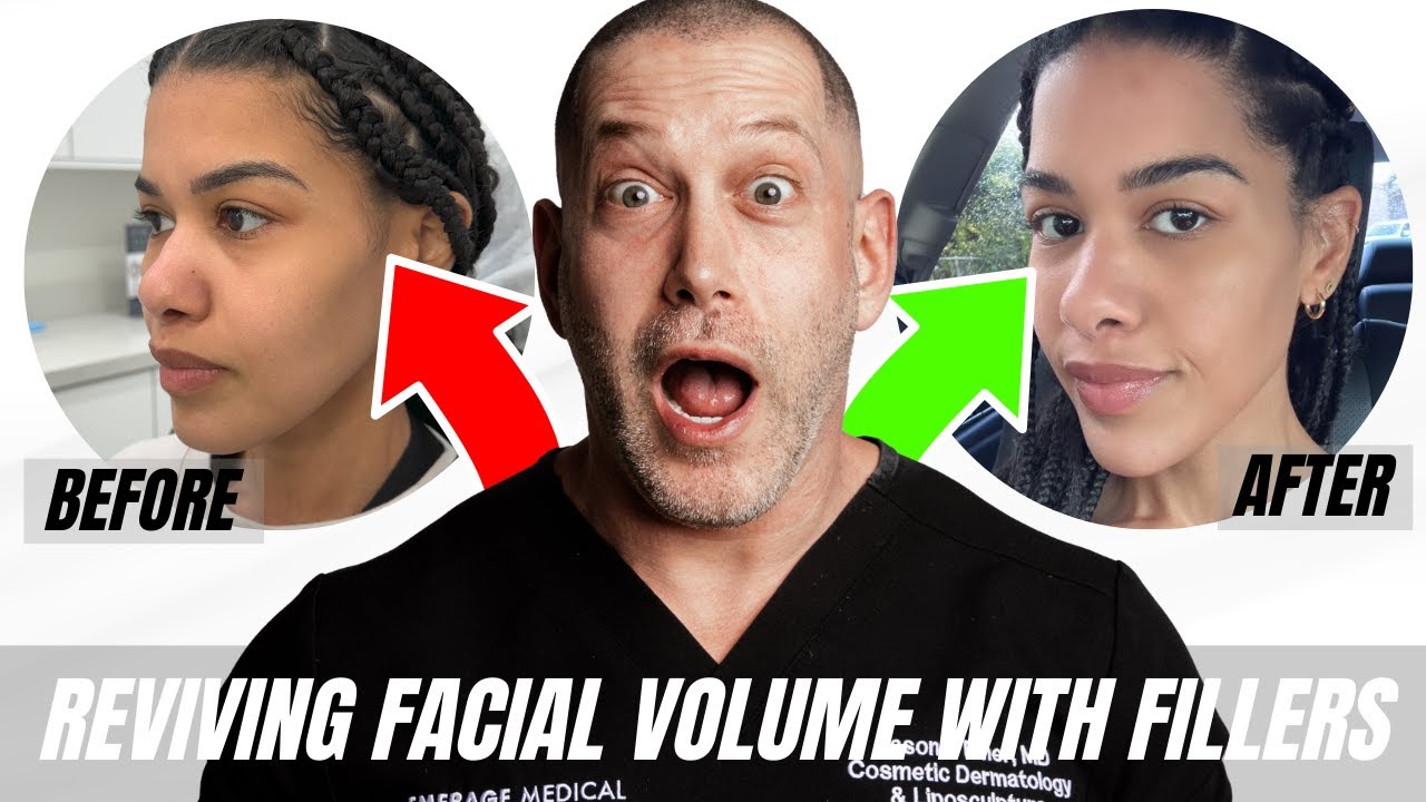Restoring Lost Facial Volume after HUGE Weight Loss | Dr. Jason Emer ...