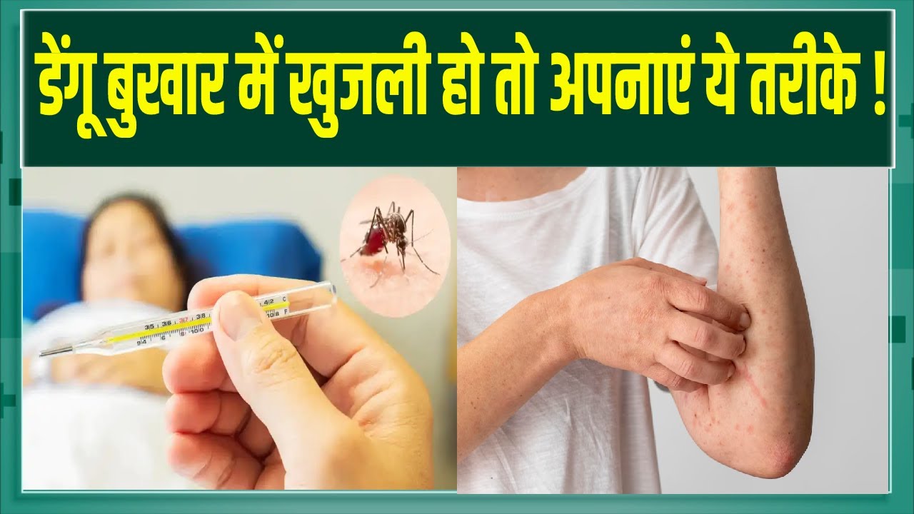 Dengue Itching: डेंगू होने पर खुजली क्यों हो जाती है? जानिए पूरी ...