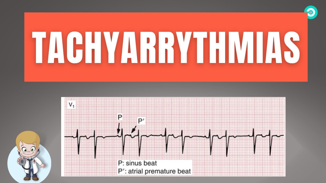 How to dignose Abnormal heart rhythm (Tachyarrythmias) On ECG : Step by ...