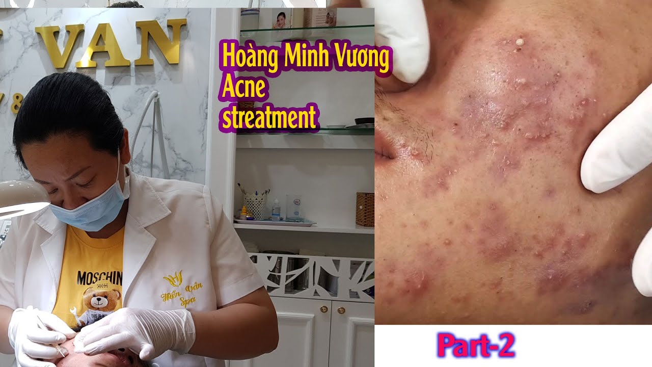 Acne treatment reputation, effective at Hien Van Spa|389I Hoàng Minh ...