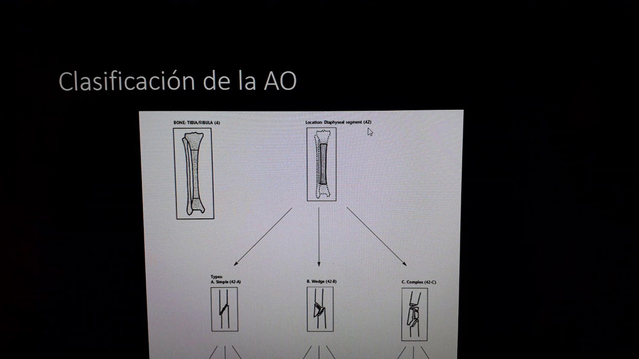 Fractura de diáfisis de tibia, clasificación AO - YouTube