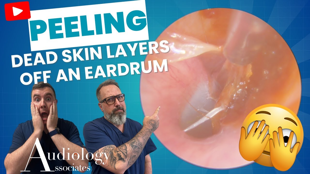 Oddly Satisfying: Audiologist Peels Layers of Dead Skin from Eardrum ...