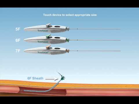 Exoseal select size - YouTube