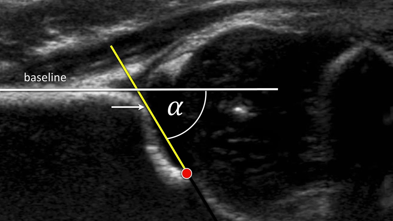 Congenital Hipdysplasia How to measure angles - YouTube