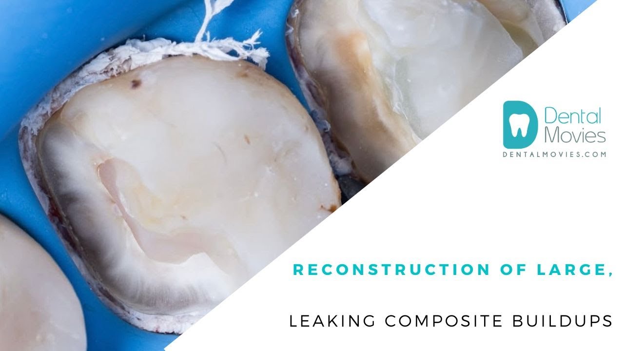 Reconstruction of large, leaking composite buildups - YouTube
