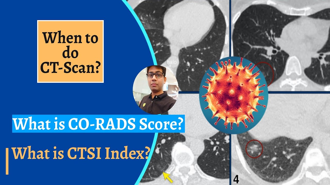 When to do CT Scan in COVID-19?| What is CORADS and CTSI?| AIIMS ...