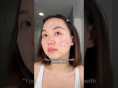 Never let acne stop you from doing what you love 🤗💖 #acne #model #acnepositivity