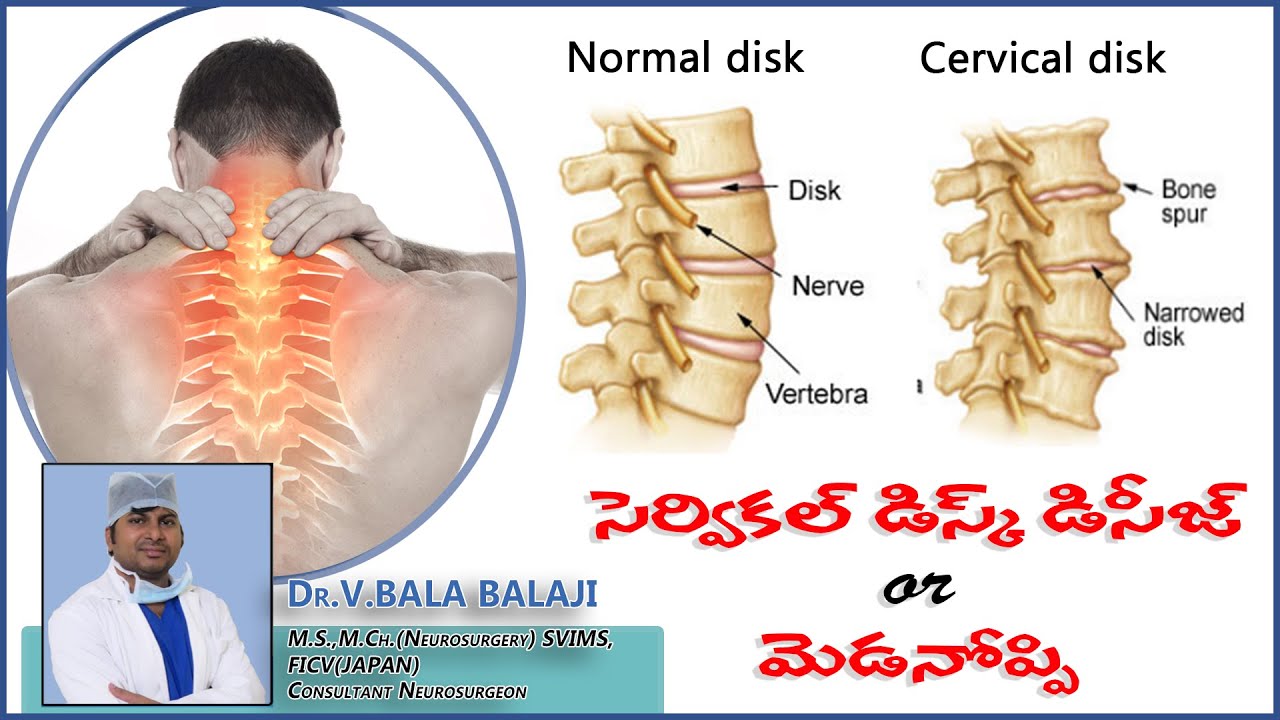Cervical Disc Disease Symptoms Treatment By Dr BalaBalaji Vosuri cervical-disc-disease-symptoms-treatment-by-dr-balabalaji-vosuri