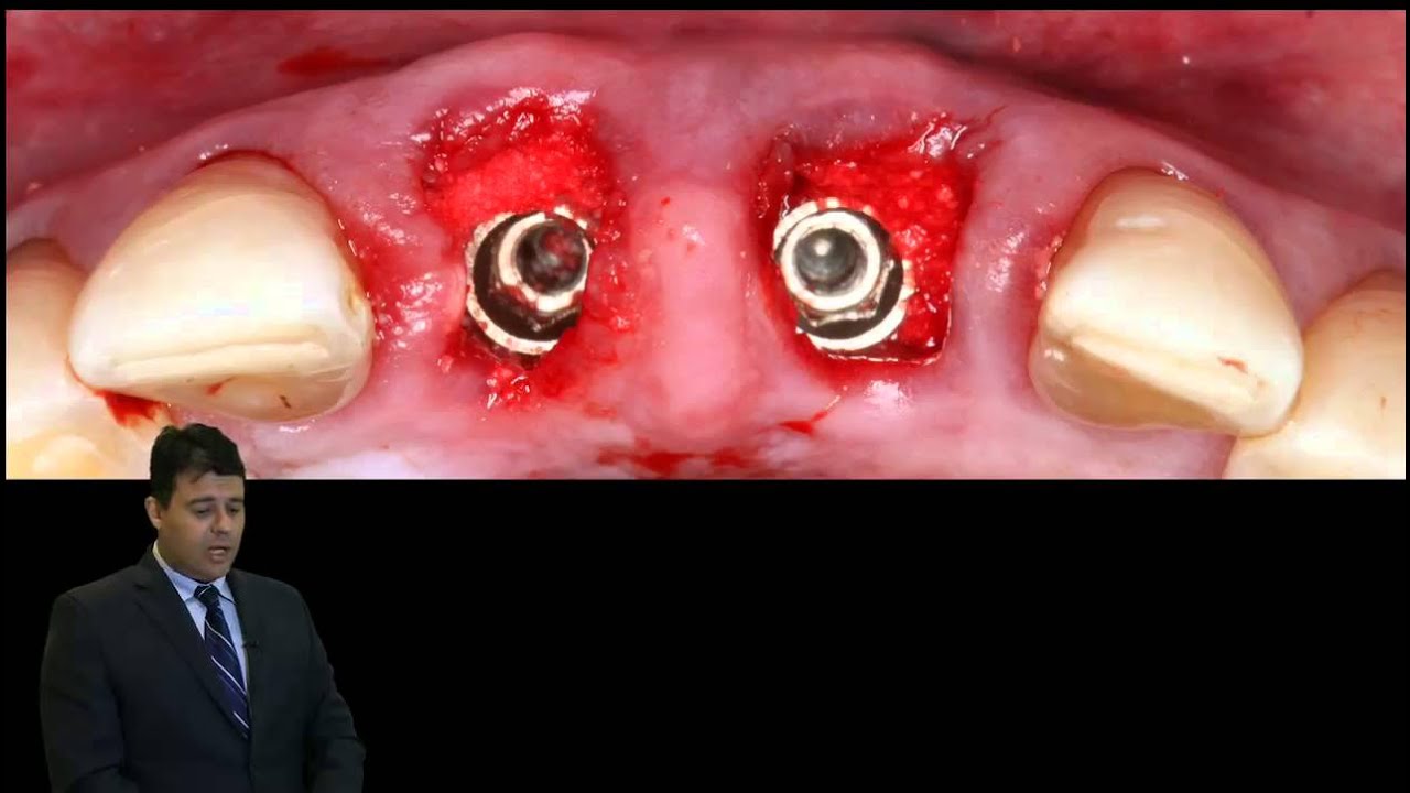 242-00 Integrated Rehabilitation Using Adjacent Implants in the ...