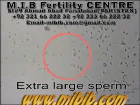 Extra large sperm ,Extra large sperm video,abnormal sperm video