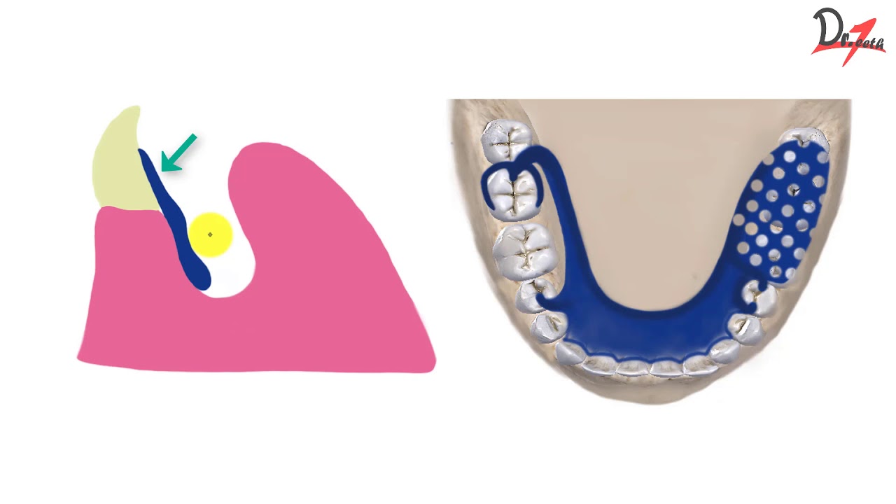 Mandibular major connector | RPD - YouTube