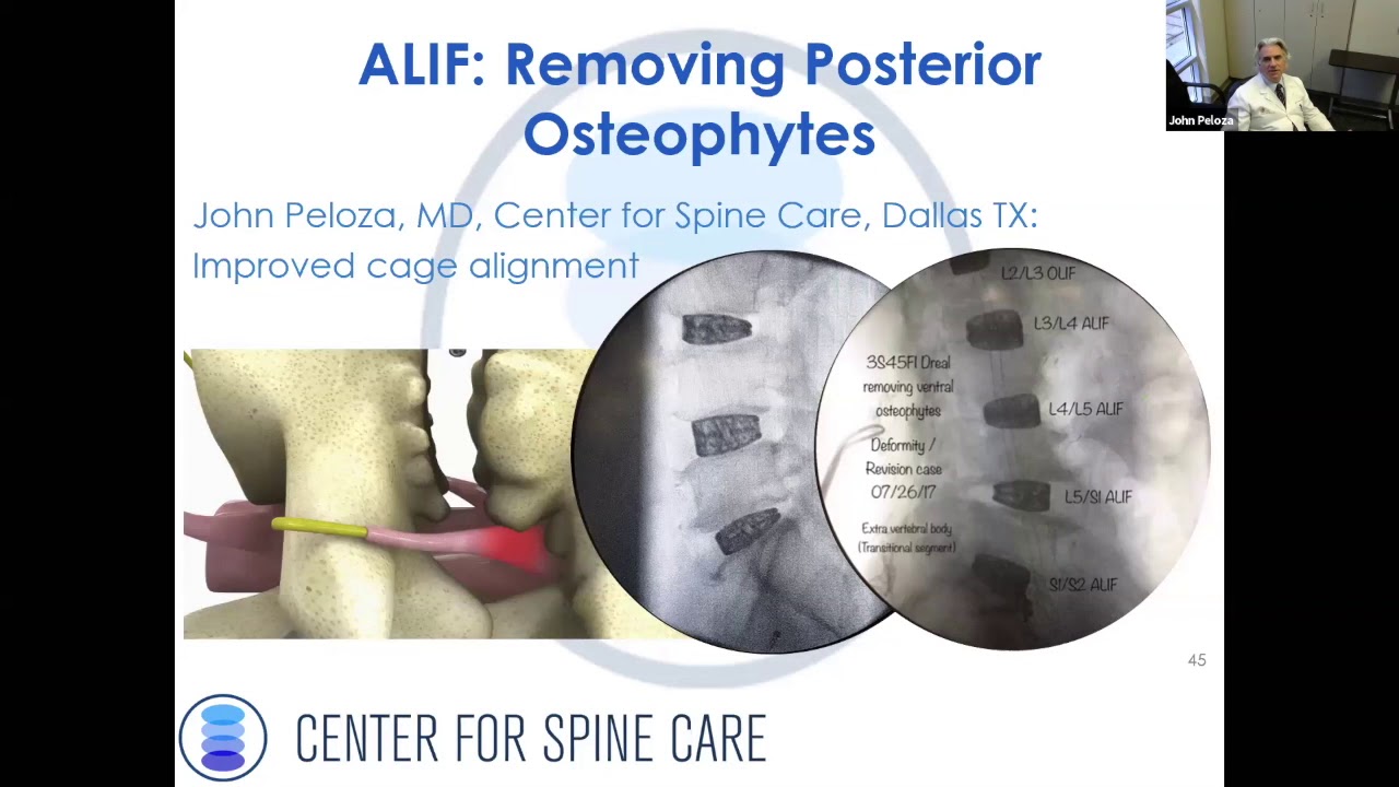 John Peloza, MD - Dreal® application for osteophyte removal during ALIF ...