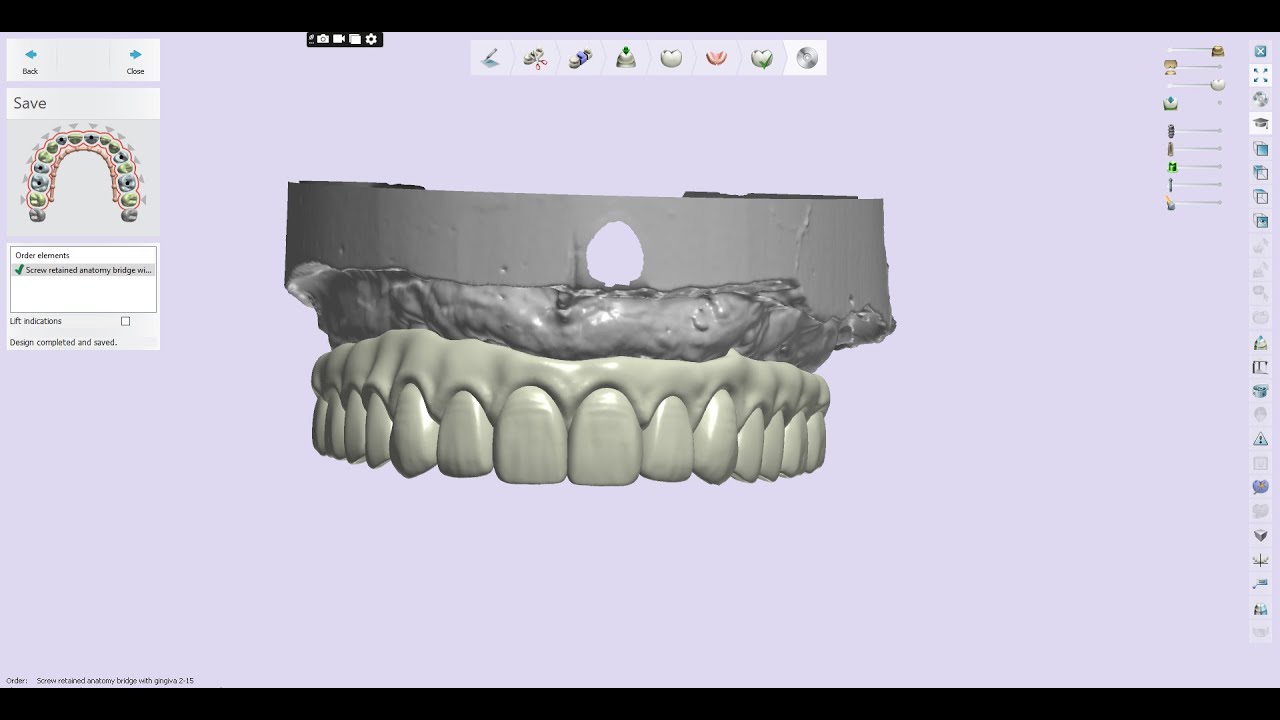 3Shape All on 6 Screw Retained Bridge with Gingiva 033023 - YouTube