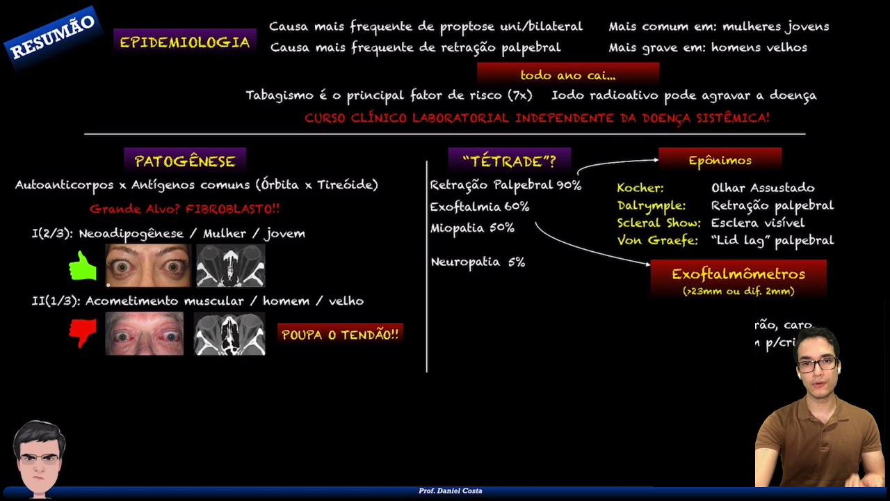 Exoftalmia Vs Proptose Proptose Ocular CLOVE