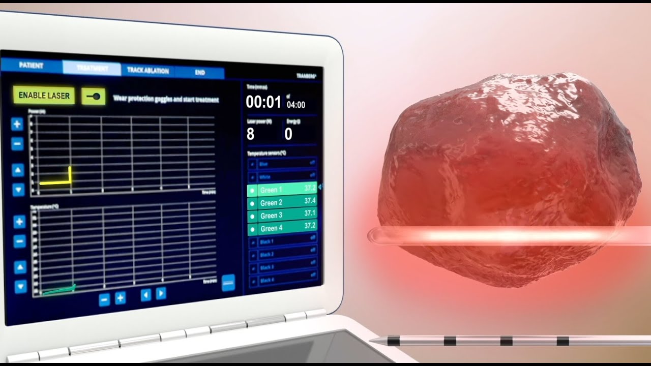 Prostate cancer laser ablation technology l #3d #animation - YouTube