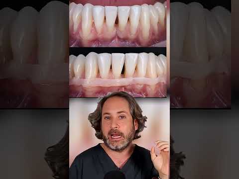 SOLUCIÓN a la SENSIBILIDAD después de una LIMPIEZA dental - FIN a los ...