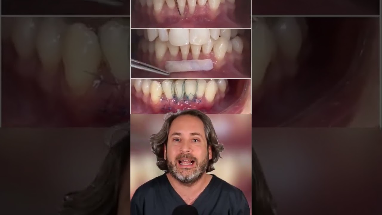 SOLUCIÓN a la SENSIBILIDAD después de una LIMPIEZA dental - FIN a los ...
