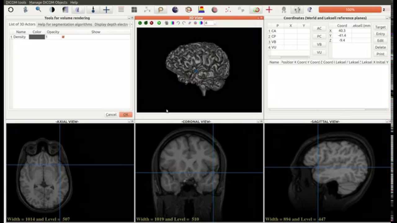 Brain Extraction
