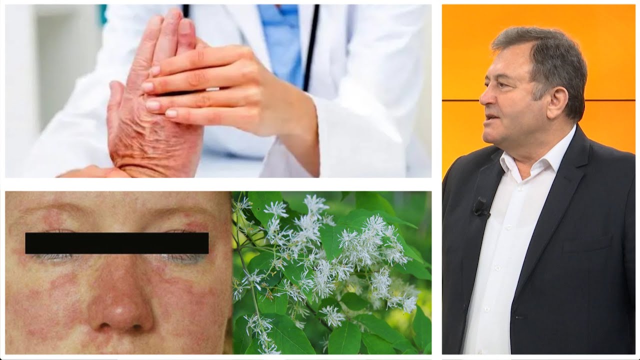 Shenjat në lëkurë që paralajmërojnë sëmundjen e rëndë / Ylli Merja jep ...