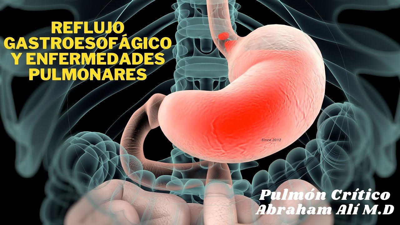 Reflujo Gastroesofágico Y Enfermedades Pulmonares Youtube