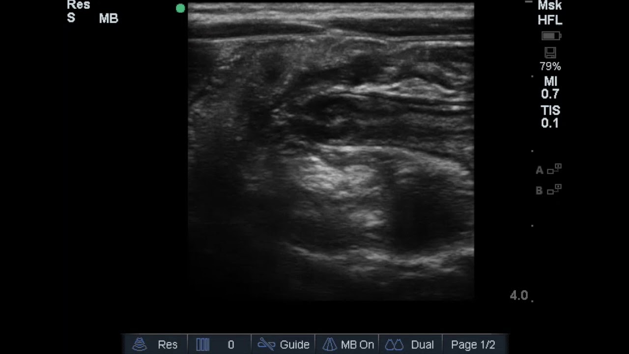 Intussusception Ultrasound Protocol